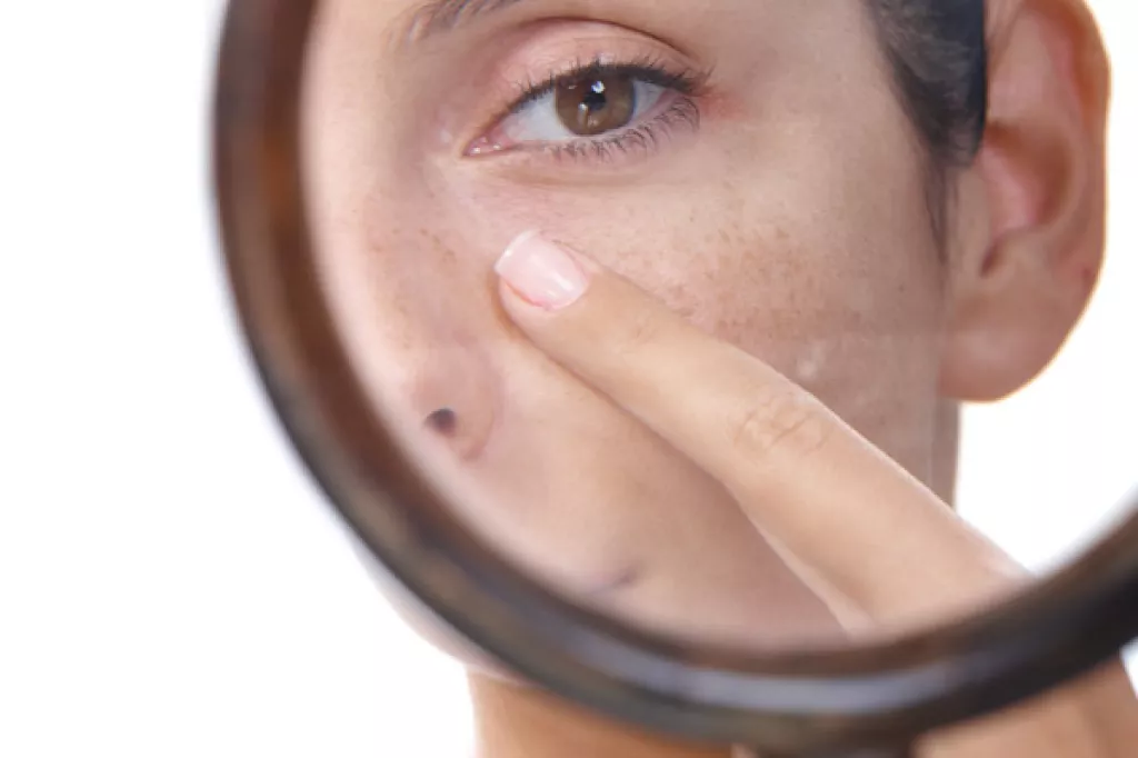 Expert Tips on How to Get Rid of Freckles