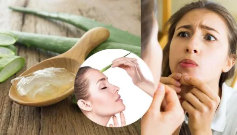 7 Best Home Remedies For Pimples And Acne That Work Fast; Remove Acne Scars