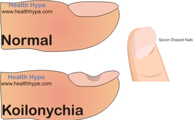 6 Things Your Fingernails Can Tell You About Your Health