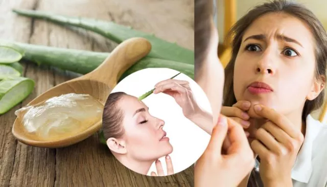 7 Best Home Remedies For Pimples And Acne That Work Fast; Remove Acne Scars
