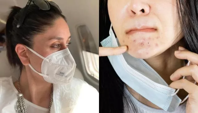 How To Cure Mask Acne? Treatment And Prevention Of Mask Acne