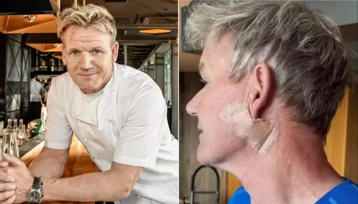 Gordon Ramsay Gets Treated For Skin Cancer, What's The Celebrity Chef's ...